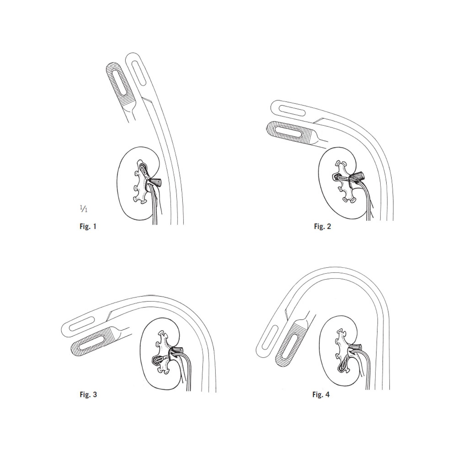 Randall Kidney Stone Forceps - Medicta Instruments